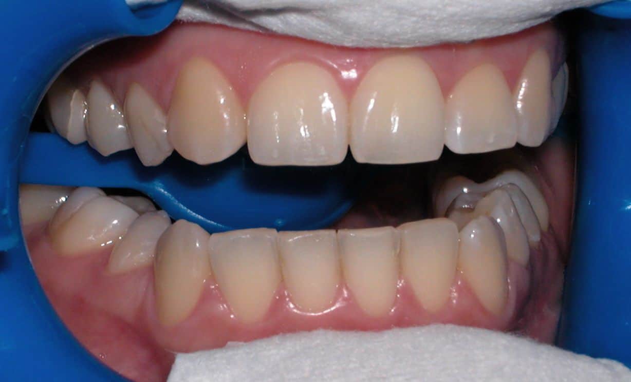 ¿Cómo puedo tener mis dientes blancos? | Matias San Martin